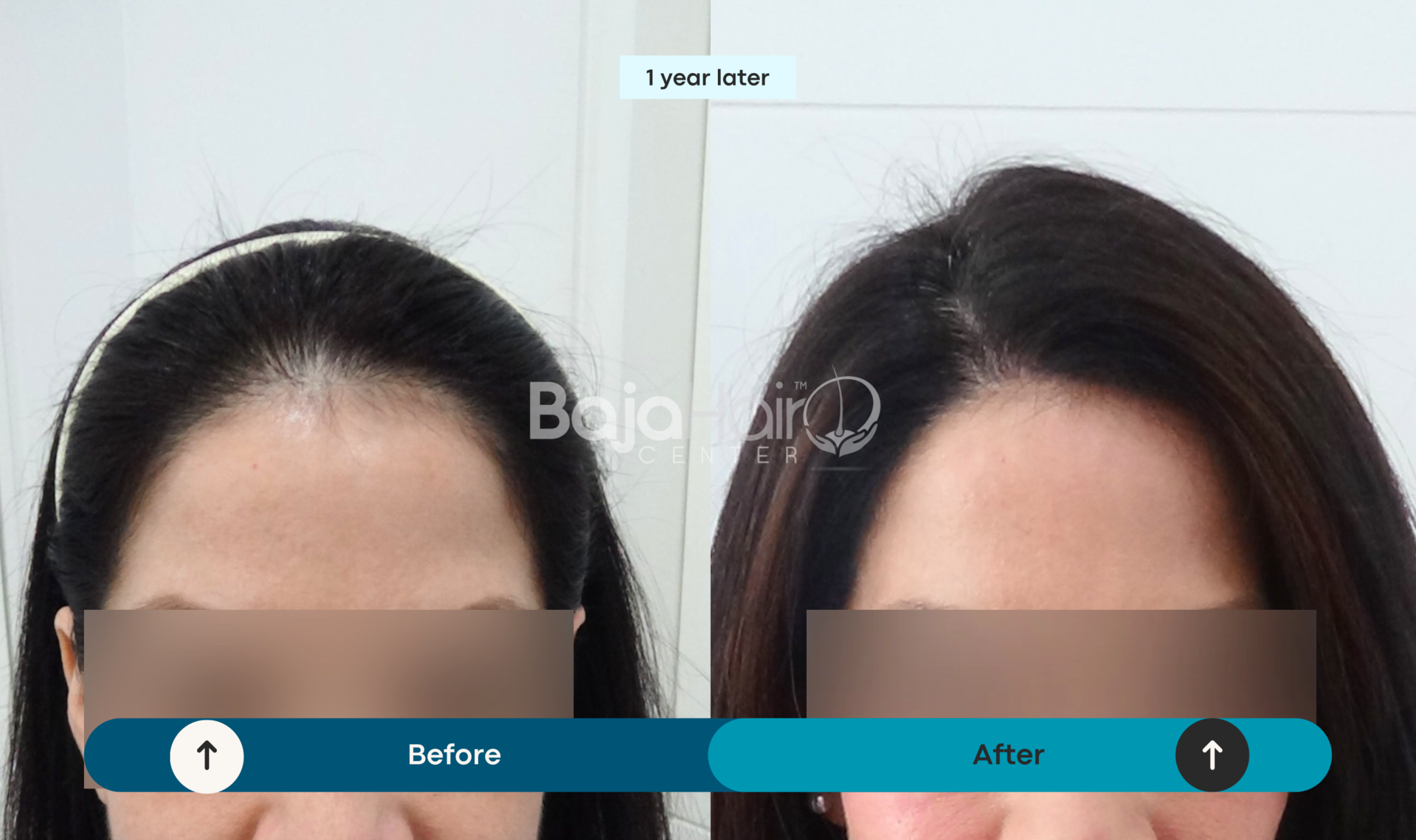 Before & After in Tijuana | Baja Hair Center
